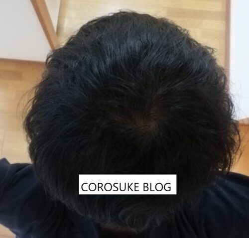 確実に髪の毛が生える方法はあるの？【男性向けに詳しく解説！】 | Corosuke Blog